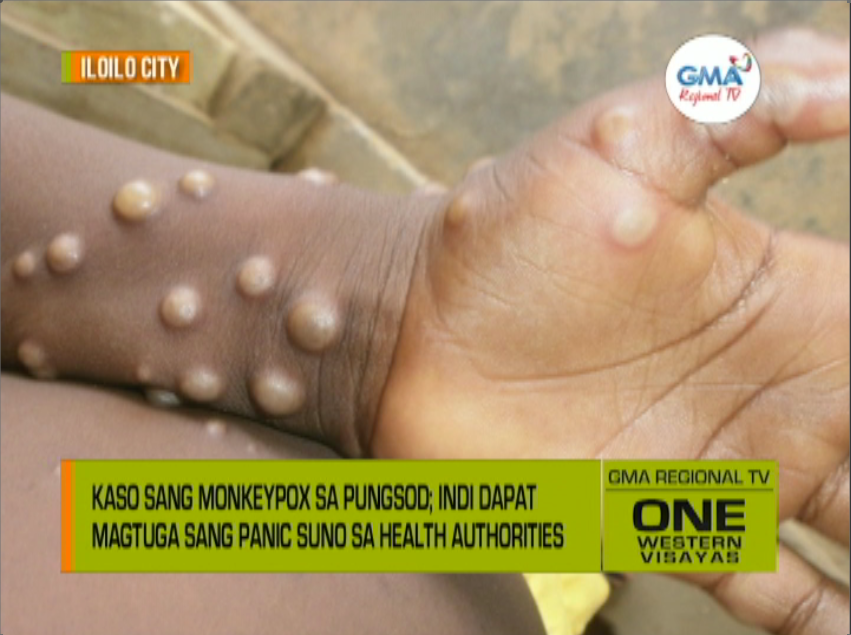 One Western Visayas: Indi Dapat Mag-panic sa Monkeypox Suno sa Health ...