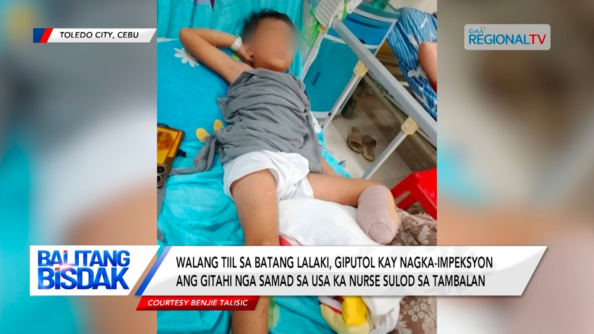 Walang tiil sa batang lalaki, giputol kay nagka-impeksyon ang gitahi nga samad