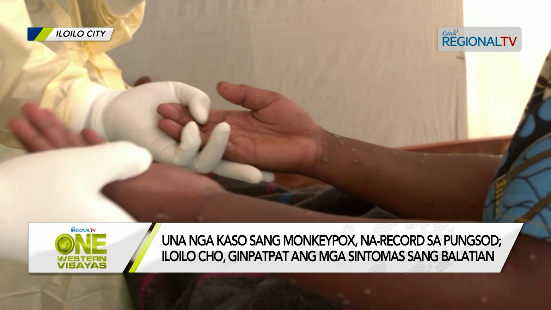 Iloilo CHO, ginpatpat ang mga sintomas sang balatian nga monkeypox
