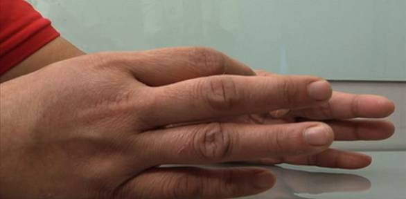 Kalyo 101: Pinoy MD's guide to calluses | GMA News Online