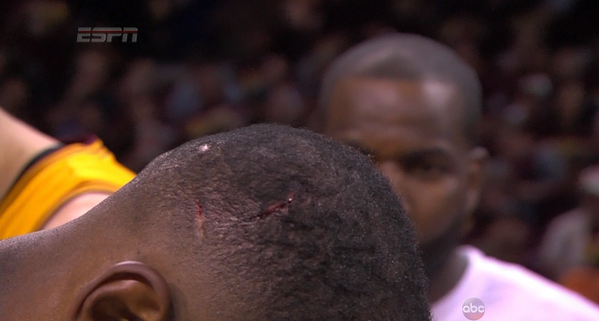 LOOK: LeBron's head sliced open after second quarter fall | GMA News Online