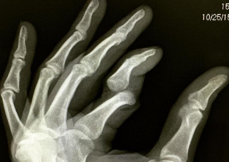 Rafi Reavis posts pictures of his gruesome finger injury | GMA News Online