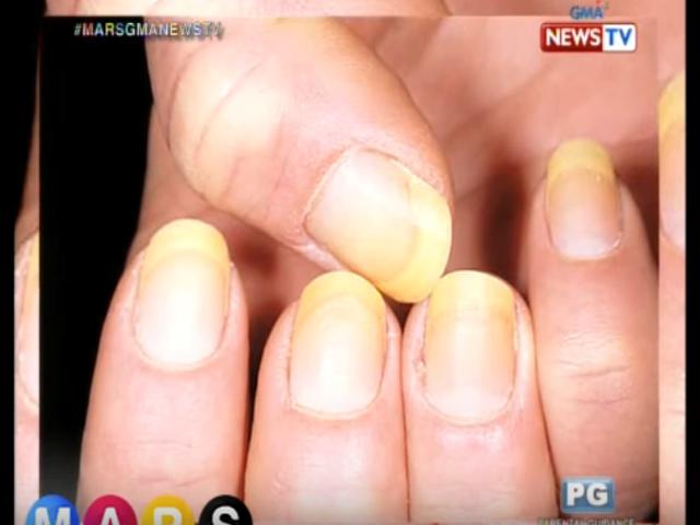 Sintomas ng sakit, puwedeng makita sa iyong kuko | GMA News Online Sintomas ng sakit, puwedeng makita sa iyong kuko | GMA News Online