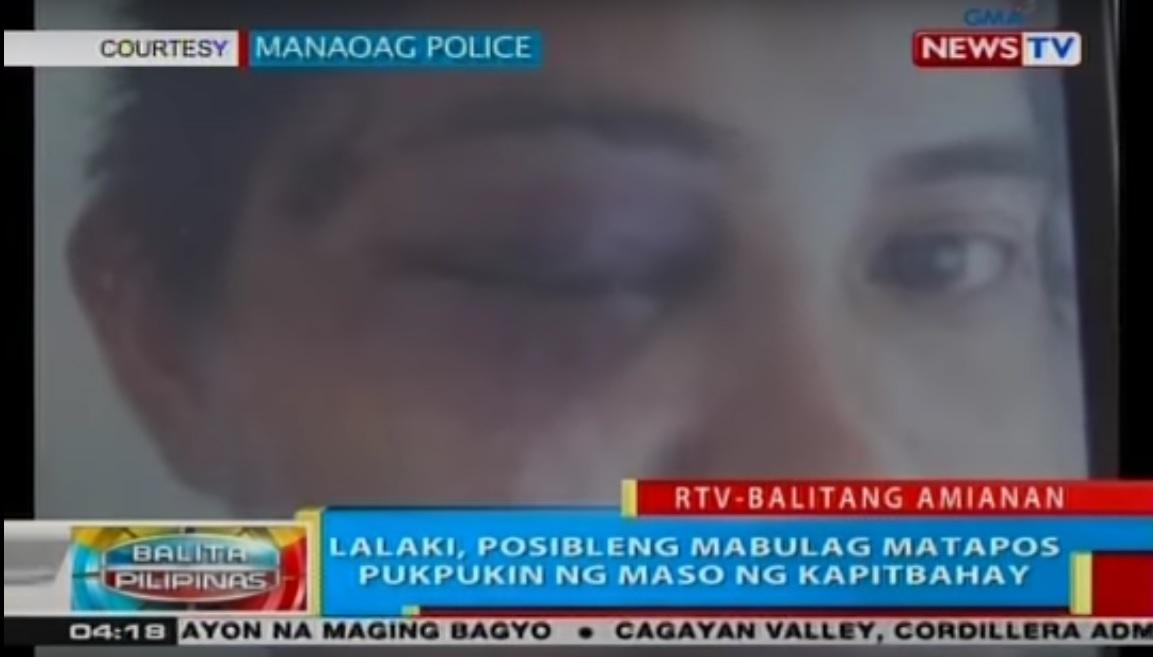 Lalaking hinataw ng maso sa mata ng kanyang kapitbahay, posible daw ... Lalaking hinataw ng maso sa mata ng kanyang kapitbahay, posible daw ...