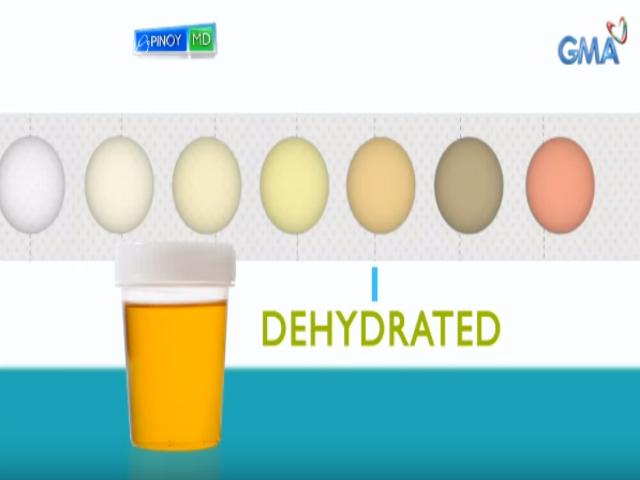 Pagbabago sa kulay ng ihi, maaaring indikasyon ng sakit | Balitambayan