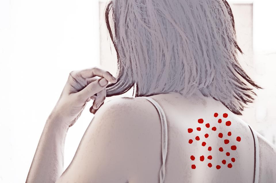 What causes back acne and what can I do about it? | GMA News Online