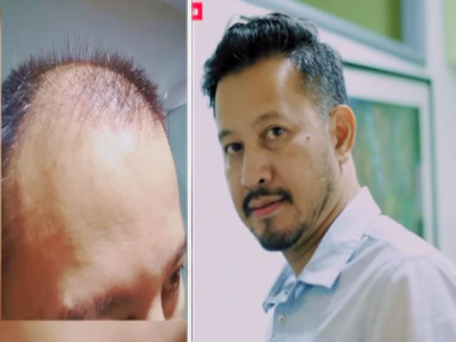 Ano ang solusyon sa pagkapanot? | Balitambayan