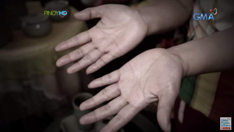 ‘Pasma’ could just be a symptom of another medical condition | GMA News ...