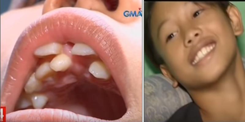 Ngipin na sungki-sungki noon, maayos na parang pang-commercial model na ...