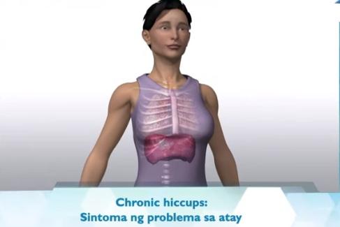 Chronic hiccups could be symptom of liver problem, doctor says | GMA ...
