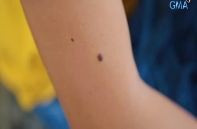 Papaano nabubuo ang nunal at ano ang kanilang kahulugan? | Talakayan ...