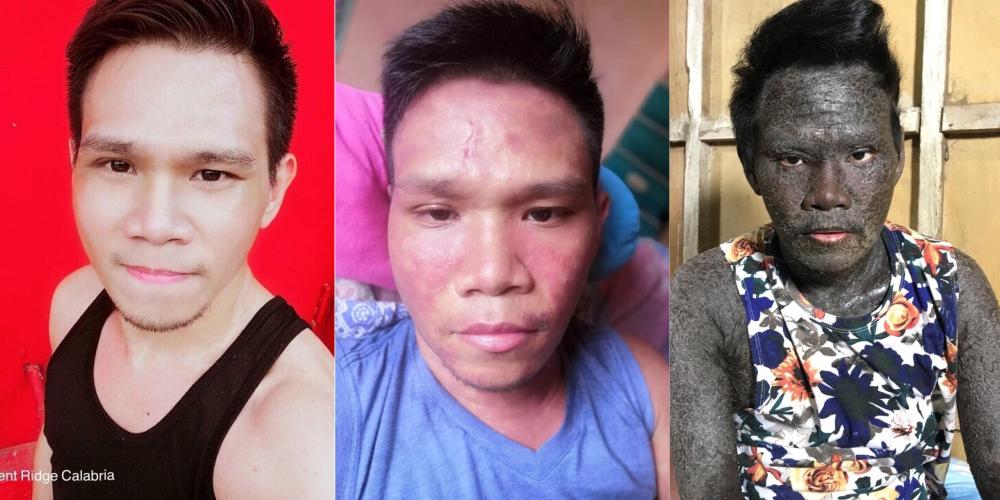 What caused this man’s entire body to turn ashen black? | GMA News Online