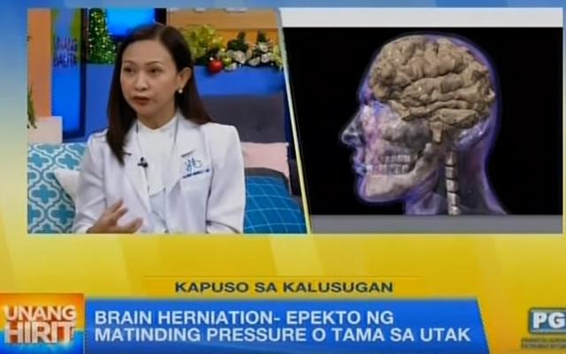 Ano ang Brain Herniation na sinasabing sanhi ng pagpanaw ni Lucio 'Bong ...