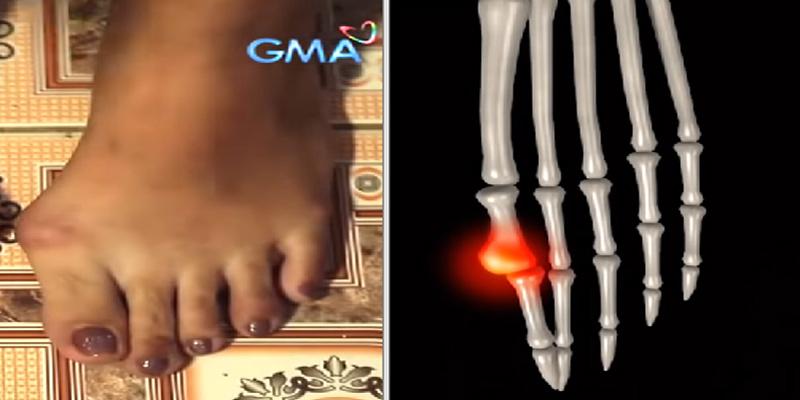 'Bunion' o bukol sa hinlalaki ng paa, saan nagmula at paano maiiwasan ...
