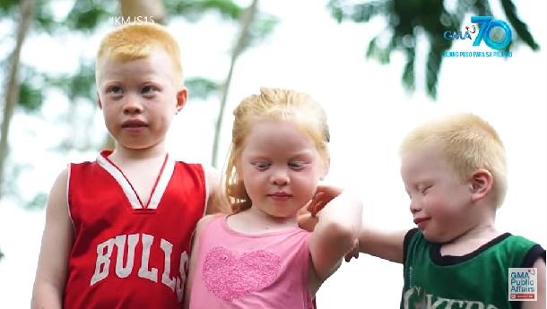 3 magkakapatid na may albinism, bakit iniuugnay sa umano'y nilalang na ...