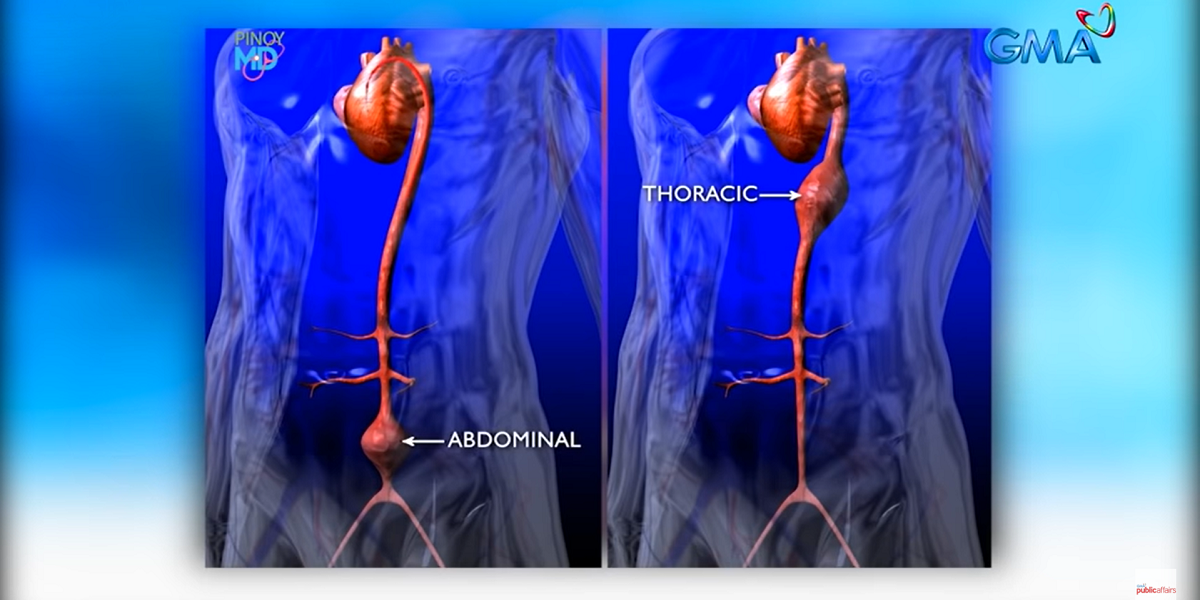 What is aortic aneurysm? Here are the dangers and risk factors | GMA ...