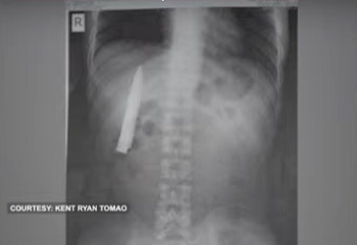 Job applicant, nadiskubreng may nakabaong kutsilyo sa katawan sa X-ray ... Job applicant, nadiskubreng may nakabaong kutsilyo sa katawan sa X-ray ...