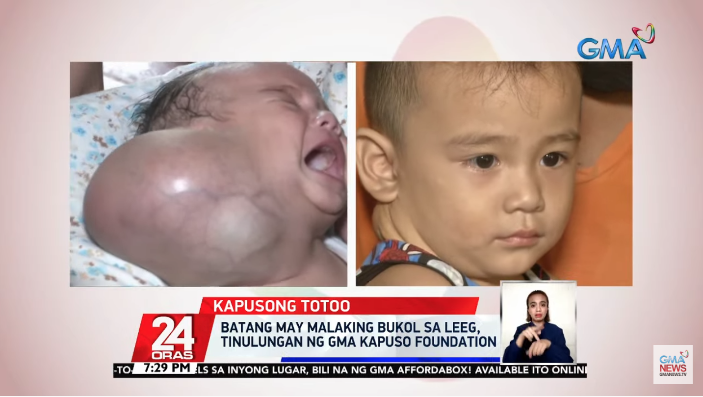 2-year-old child with huge neck lump gets surgery with GMA Kapuso ...