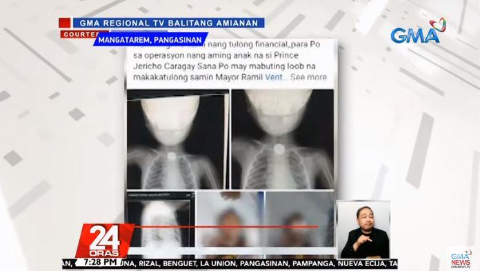 Peso coin gets stuck in child's throat in Pangasinan | GMA News Online