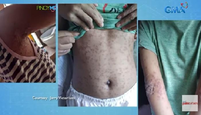 Kati sa balat na 'scabies' o galis-aso, sa aso nga ba nakukuha ...