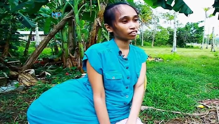 Maliit na umbok sa balakang ng isang babae, naging malaking bukol ...