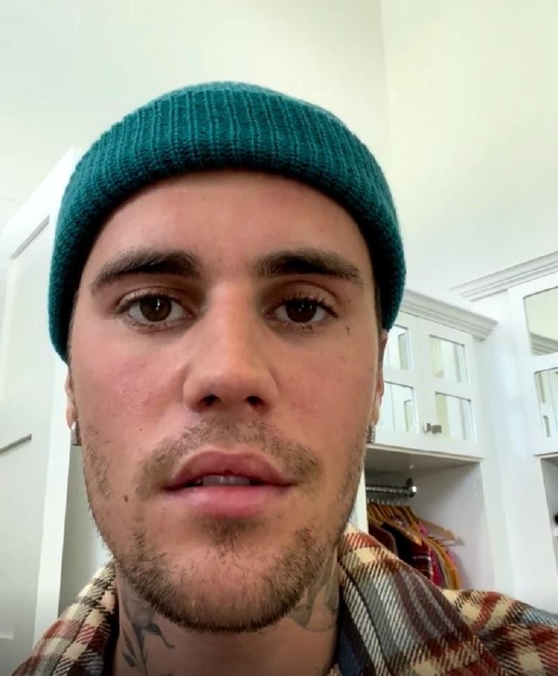 Justin Bieber, naparalisa ang kalahati ng mukha dahil sa Ramsay Hunt ... Justin Bieber, naparalisa ang kalahati ng mukha dahil sa Ramsay Hunt ...