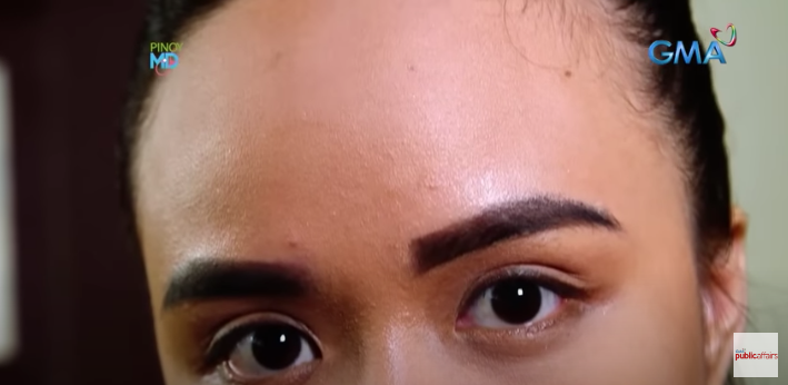 There’s a procedure called forehead reduction for those with wide noo ...