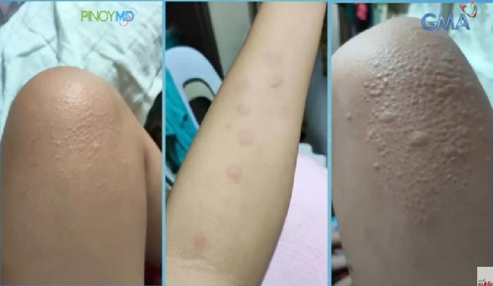8 pagkain na itinuturing 'major' food allergens o nagdudulot ng skin ...