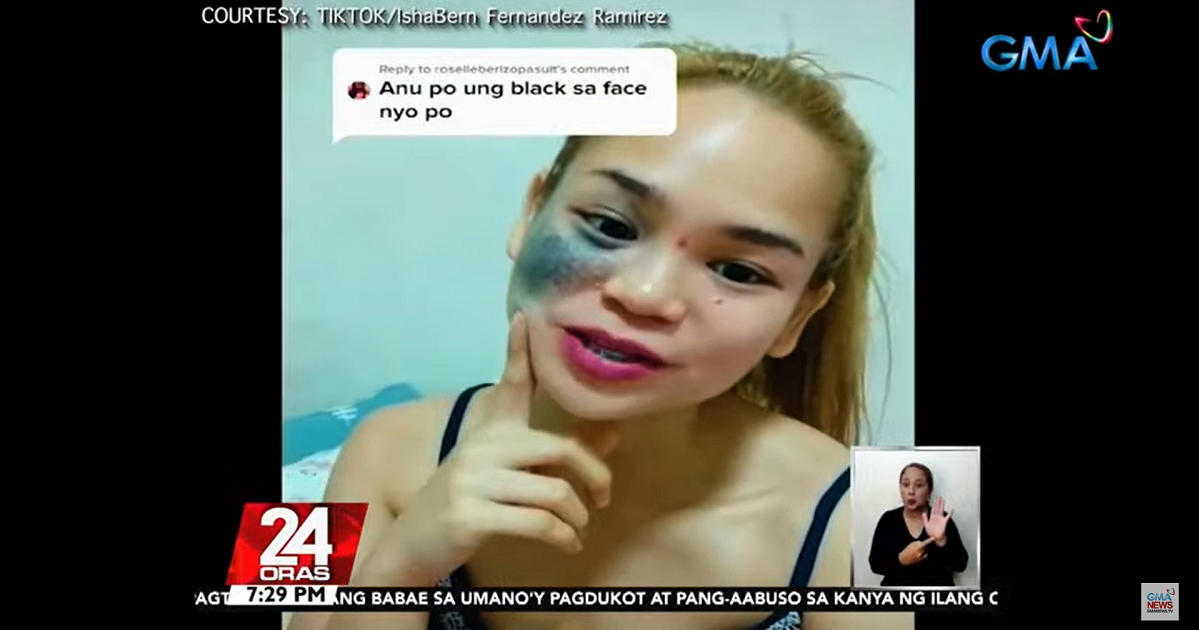 What causes birthmarks? Kuya Kim explains | GMA News Online