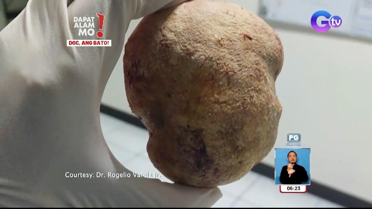 Doctor removes a massive 400-gram urinary bladder stone from a patient ...