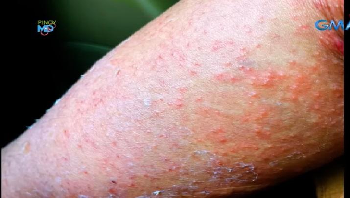 Babaeng gustong maging kutis-artista, nasira daw ang balat sa peeling ...