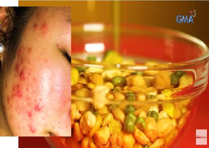 Pagkain ng mani, sanhi nga ba ng acne breakout? | Balitambayan