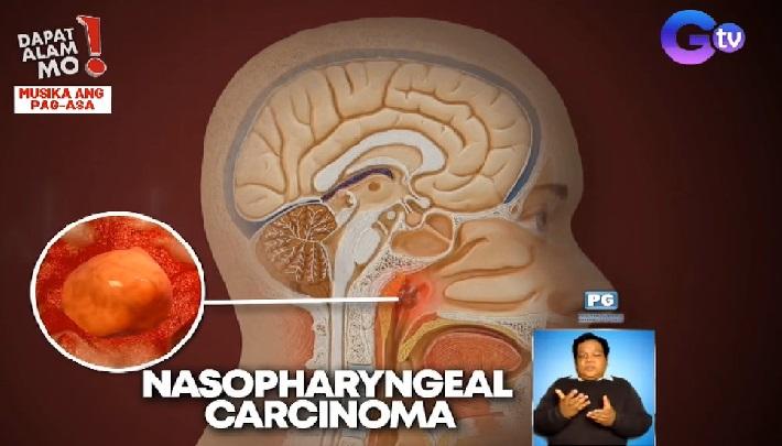 Mga sintomas ng nasopharyngeal carcinoma na isang uri ng cancer, alamin ...