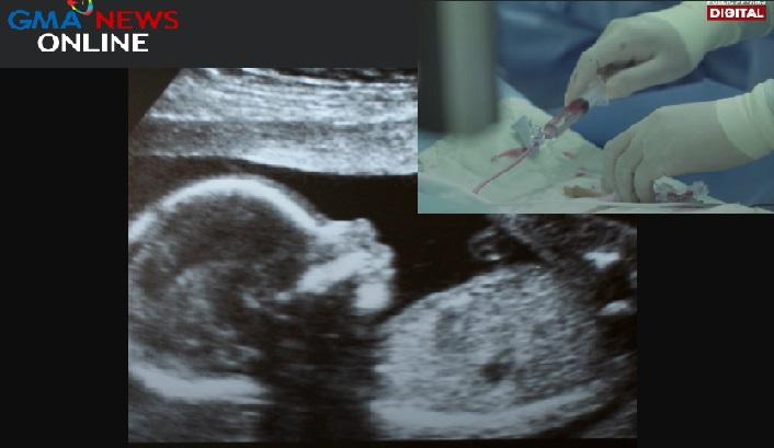 Fetus, matagumpay na inoperahan sa utak habang nasa sinapupunan ...