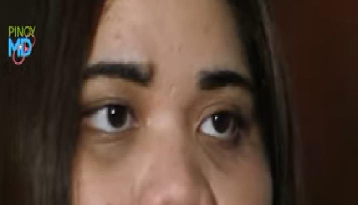 Maitim at malalim na eyebags, alamin kung bakit nangyayari at paano mawawala | Balitambayan