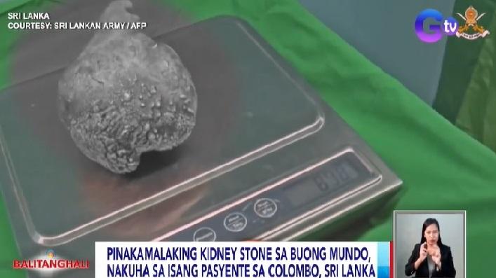 Kidney stone na nakuha sa isang pasyente sa Sri Lanka, mas malaki pa ...