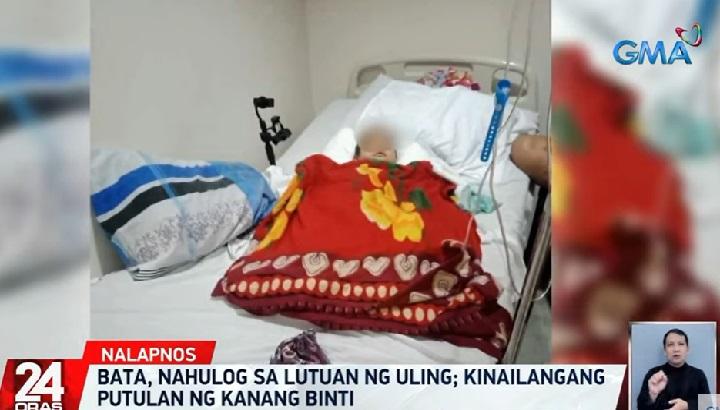 Batang nalapnos nang mahulog sa lutuan ng uling, kinailangang putulan ...