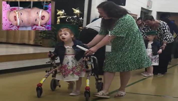 Conjoined twins na may 2% lang noon na mabuhay, nakapagtapos na ng kinder ngayon | Balitambayan