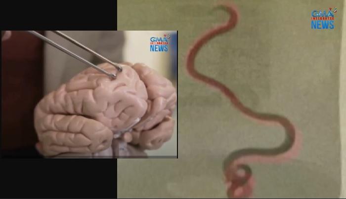 Bulate na karaniwang nakikita sa sawa, nakita sa utak ng tao | Balitambayan