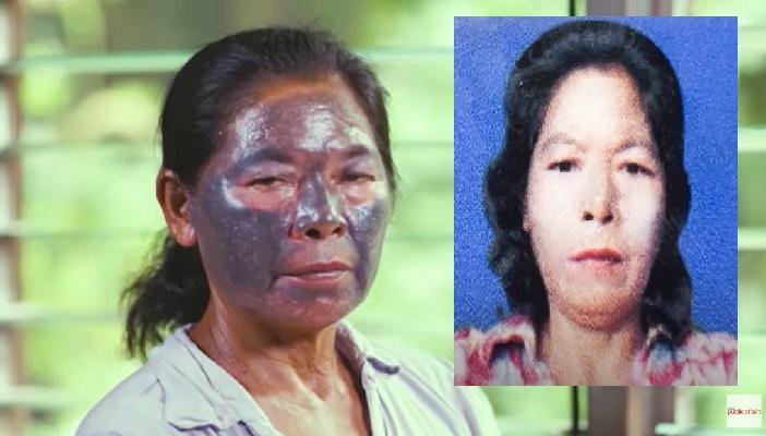 Mukha ng babae, nangitim na tila nasunog dahil sa astringent na nabili niya sa bangketa ...