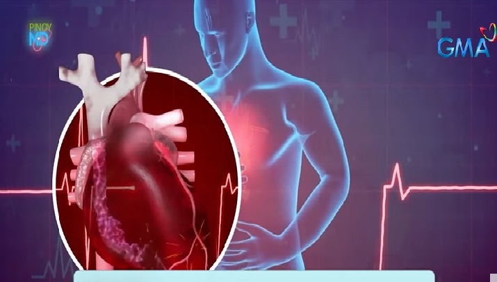 Ano ang kondisyon sa puso na dextrocardia at dapat ba itong ikabahala ... Ano ang kondisyon sa puso na dextrocardia at dapat ba itong ikabahala ...