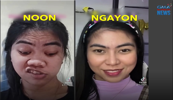 Tiktoker na bina-bash noon dahil sa pangong ilong, nakaka-in love na ...