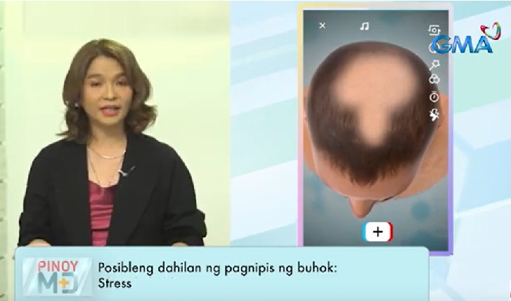 Pagnipis ng buhok, kaya pa bang malunasan? | Balitambayan