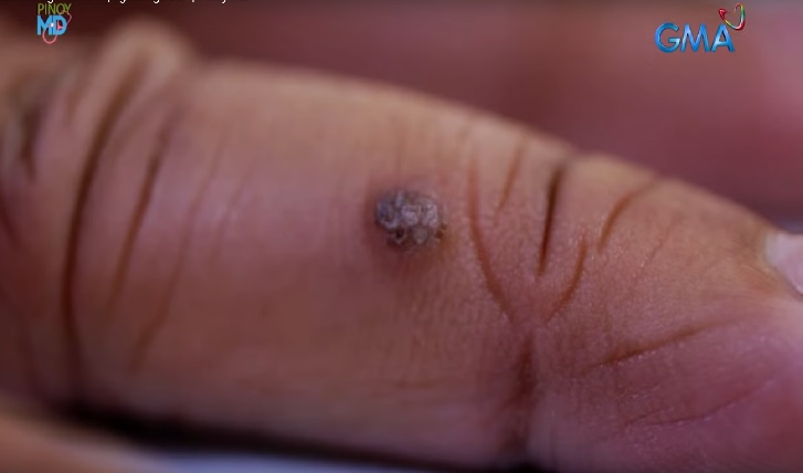 Kulugo, paano nga ba tumutubo sa katawan, at ligtas bang basta na lang ...