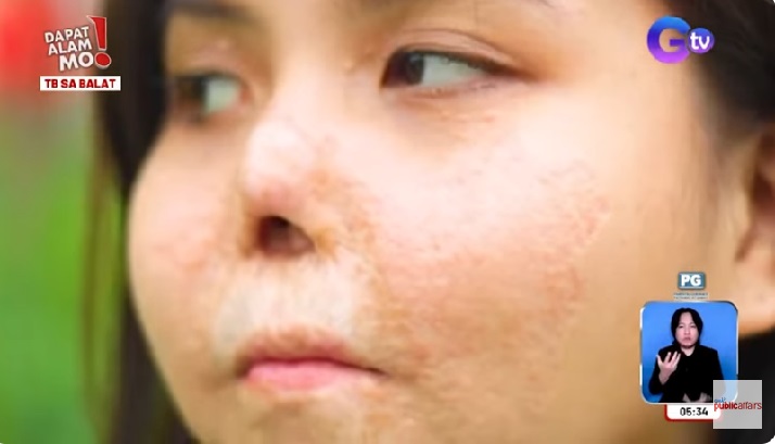 Skin tuberculosis na mistulang kumakain ng balat, ano ang dahilan at mga sintomas? | Balitambayan