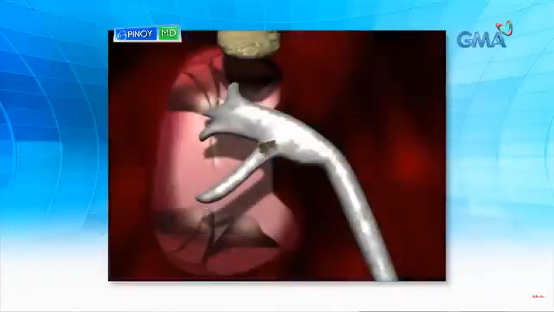 ALAMIN: Ano ang mga haka-haka tungkol sa pagkakaroon ng kidney stones ...