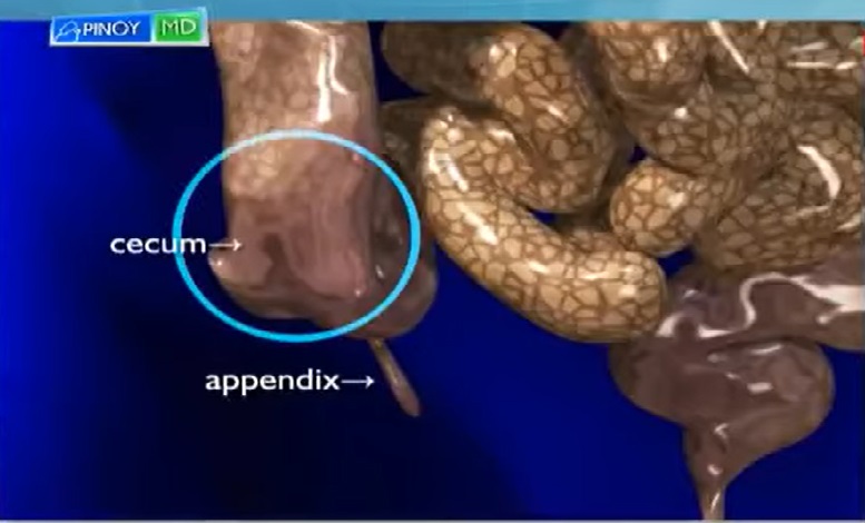 Appendicitis, mas madaling ma-diagnose sa lalaki kaysa sa babae ...
