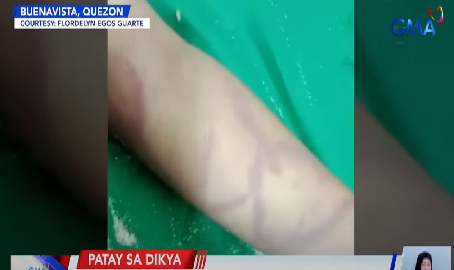5-anyos na babae, patay matapos madikitan ng box jellyfish sa Quezon | Balitambayan
